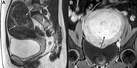 Effect Of Magnetic Resonance Imaging Characteristics On Uterine Fibroi
