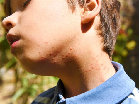 9 Bug Bite Pictures How To Identify Common Types Of Bug Bites