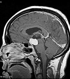 Neurocirujano En México Df Dr Agustín Dorantes Argandar Adenoma De