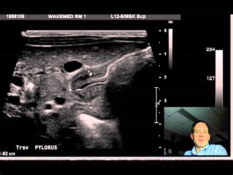 Pylorus Ultrasound