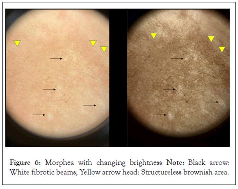 Diagnostic Accuracy Of Dermoscopy In Some Hypopigmented Lesions O