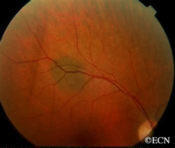 Choroidal Nevus New York Eye Cancer Center