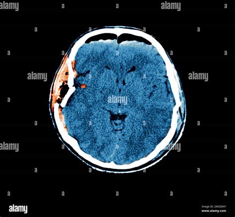 Fractured Skull Coloured Computed Tomography Ct Scan Of A Section
