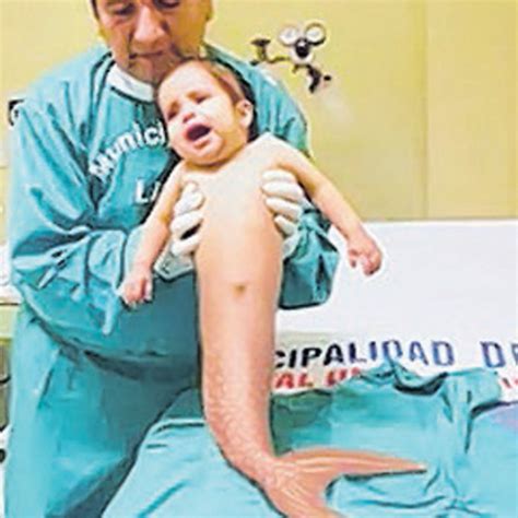 Mermaid Syndrome