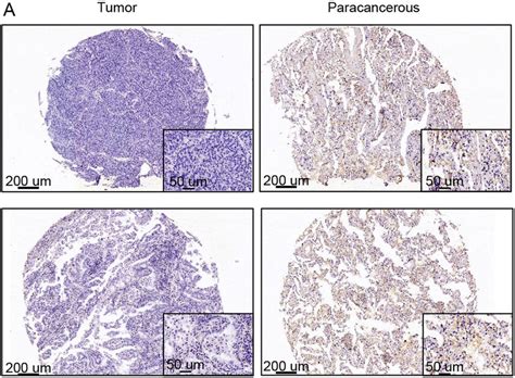 Representative images of RS1 protein expressed in clinical samples ...