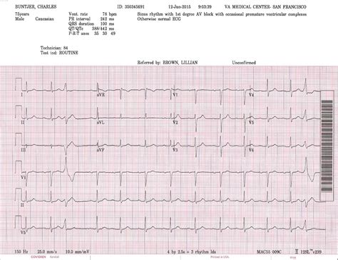 Ekg Before Stress Test 2015 06 12