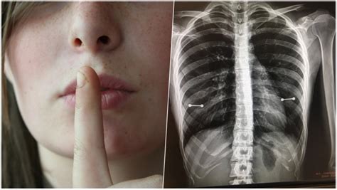 Girls Nipple Piercings Are Revealed To Her Mother Through An X Ray