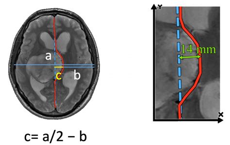 What Is A Midline Shift Of The Brain At Rene Ackerman Blog