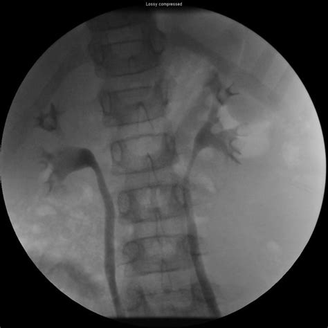 Voiding Cystourethrogram Demonstrating Grade Iii Vesicoureteral Reflux