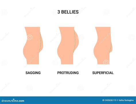 Types Bellies Of Human Body Big Belly With Overweight Sagging