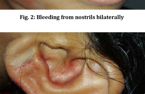 Figure 1 From Hematohidrosis A Rare Bleeding Phenomenon Semantic Scholar