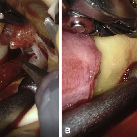 A Papillary Fibroelastoma Measuring 5 Mm On The Commissure Of The