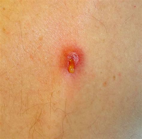 Mrsa Furuncle