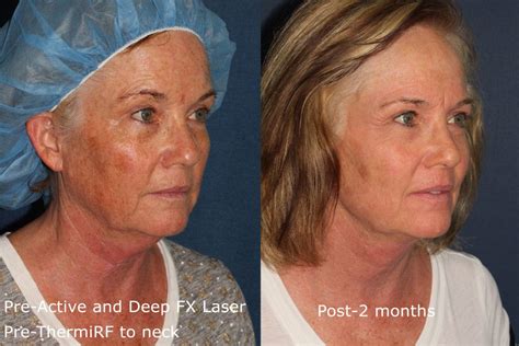 Ablative Laser Resurfacing Vs Non Ablative Laser Treatments Choosing