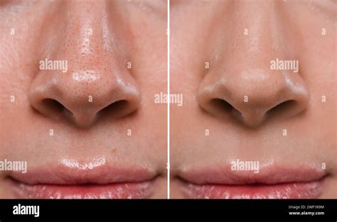 Blackhead Treatment Before And After Collage With Photos Of Woman Closeup View Stock Photo