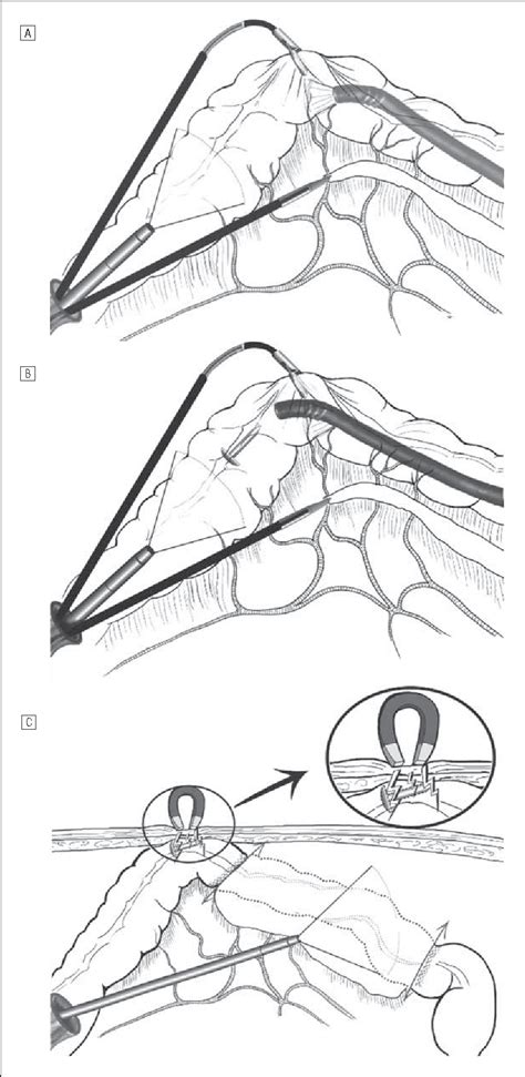 Figure 1 From Single Access Laparoscopic Sigmoidectomy As Definitive Surgical Management Of
