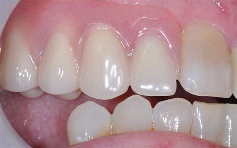 Semi Precision Root Anchors For Partial Dentures Decisions In Dentistry