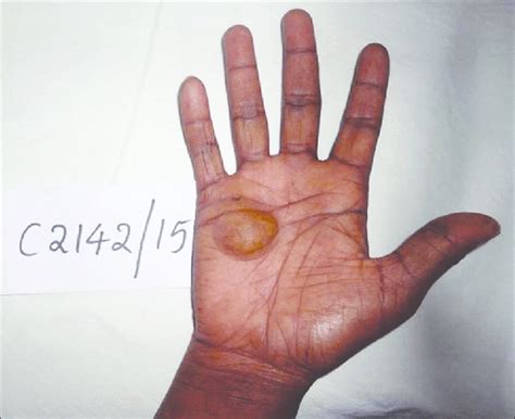 Swelling Between Fourth And Fifth Metacarpal Spaces Over The Palmar