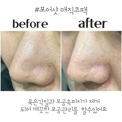 코 피지 제거 방법 초보자도 가능 리뷰 월간토마토