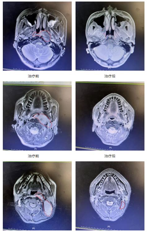 精准放疗给鼻咽癌患者带来新希望技术前沿科研教学科研教学华中科技大学协和江北医院武汉蔡甸区人民医院