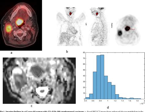 Figure 1 From Relationships Between Histogram Analysis Of Adc Values