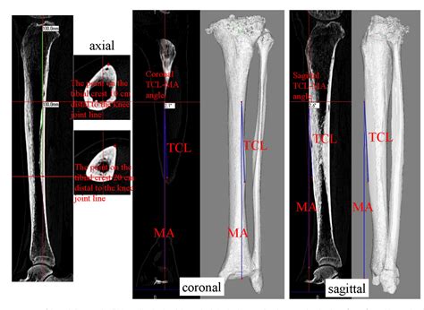 Figure 2 From The Tibial Crest As A Practical Useful Landmark In Total Knee Arthroplasty