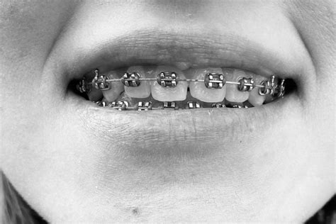 Are Veneers Permanent