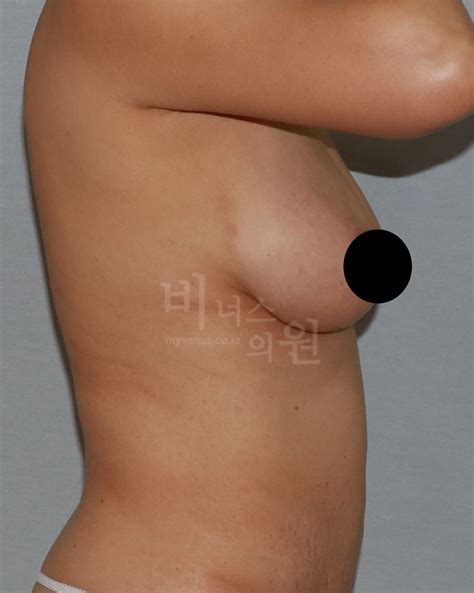 지방흡입전문 비너스의원 크고 처진 유방 교정을 위한 가슴축소술은 가슴지방흡입