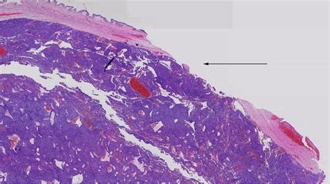 Part Of Tumor Pseudocapsule Remains In The Tumor Bed But There Are No Download Scientific