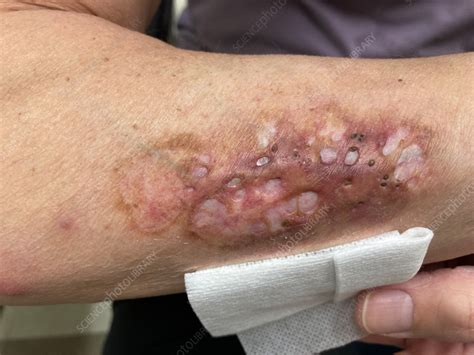 Pyoderma Gangrenosum Stock Image C056 1090 Science Photo Library