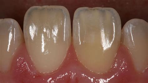 Blocking Out The Dark Tooth