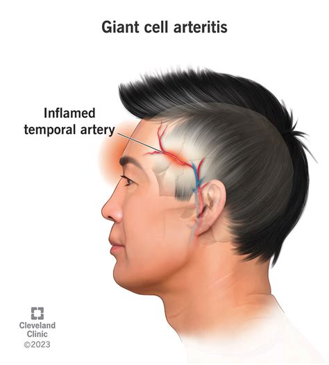 Giant Cell Arteritis Symptoms And Treatment