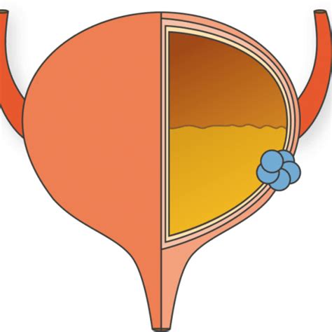 Bladder Cancer Types Infographic