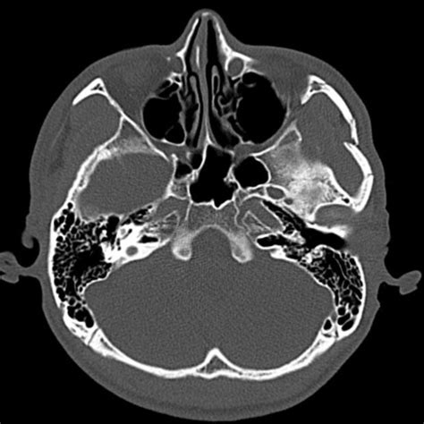 관골궁 골절 후 이 정도 상태일 경우 수술을 꼭 해야할까요 지식in