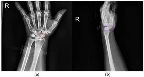 The Detection And Classification Of Scaphoid Fractures In Radiograph By