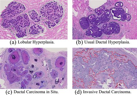 Correct Interpretations From The Proposed Cad System In The Lesion Wise