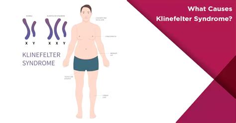Klinefelter Syndrome Xxy Syndrome Symptoms Causes 52 Off