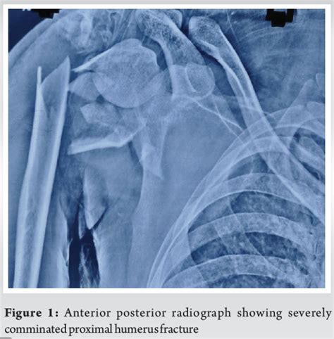 A Case Report Interposition Arthroplasty For Post Traumatic Elbow