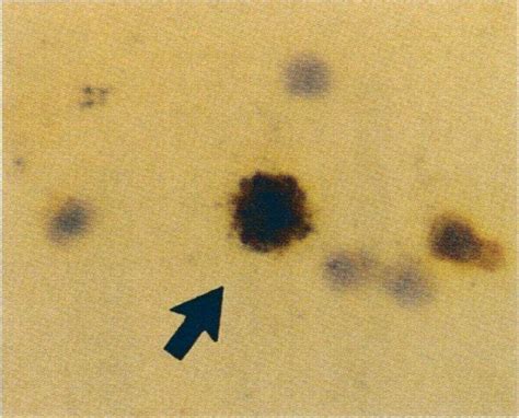 simultaneous detection of cd8 antigen and ifn y mrna in t lymphoblasts