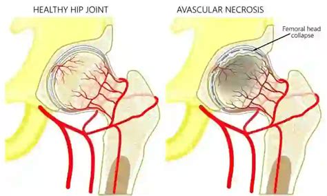 Osteonecrosis Of Femoral Head Femoral Head Osteonecrosis Avascular