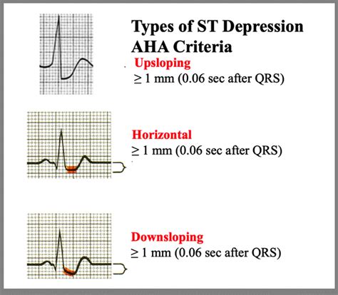 St Depression