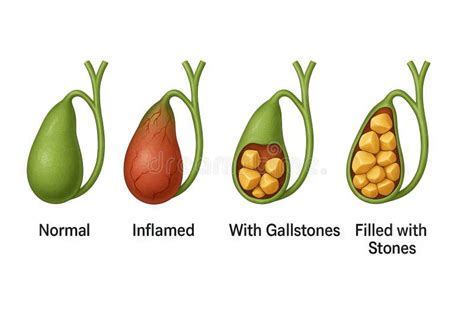 Illustration Showing Stages Of Gallbladder Health Including Normal