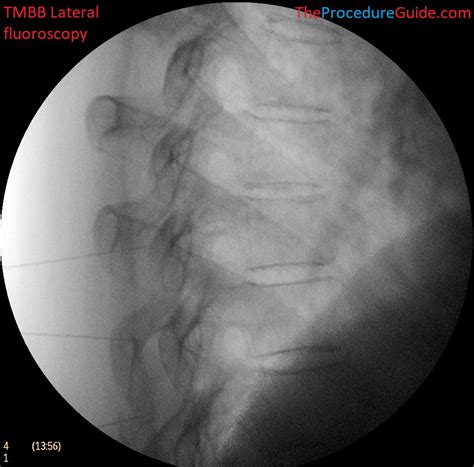 Fluoroscopic Guided Cervical Medial Branch Radiofrequency Ablation