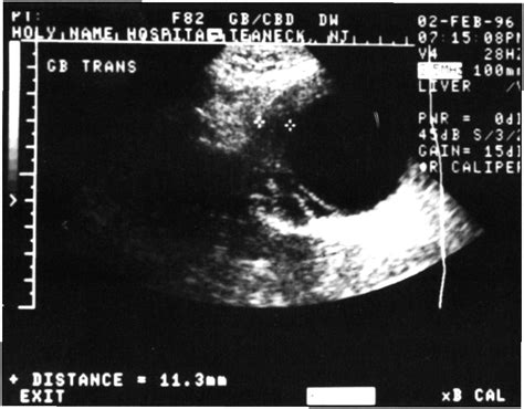 Figure 1 From Gallbladder Volvulus With Gangrene Case Report And Review Of The Literature