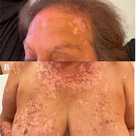 A Erythematous Vesicular Cutaneous Rash After 3 Months Of Therapy Download Scientific Diagram