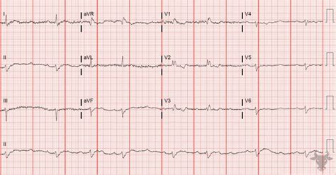 Second Degree Atrioventricular Block Mobitz Ii Ecg Stampede