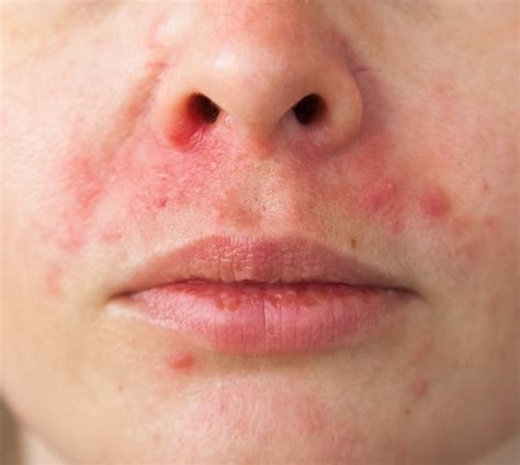 Perioral Dermatitis Treatments Heal The Rash Around Your Mouth And Nose