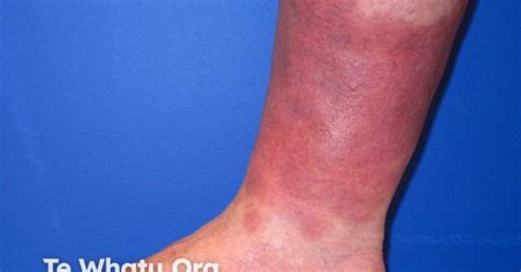 Acute Lipodermatosclerosis Image