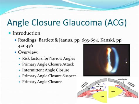 Ppt Diagnosis And Management Of Angle Closure Glaucoma Powerpoint Presentation Id 5401465