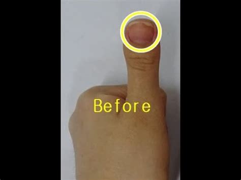 Clubbed Thumbs Surgery By Dr Ahn Youtube